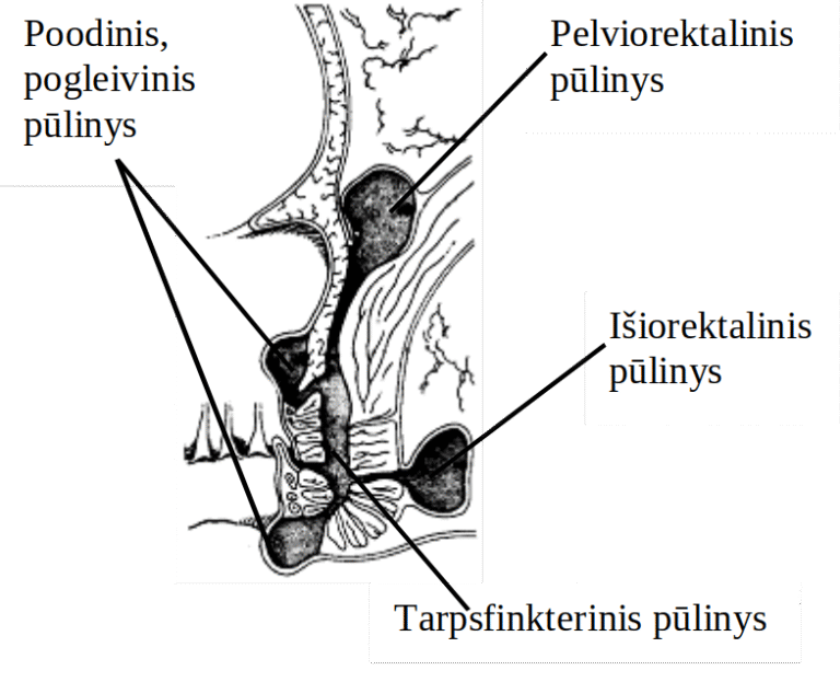 Ūminis paraproktitas – Simptomai ir gydymas | Z Klinika Vilniuje